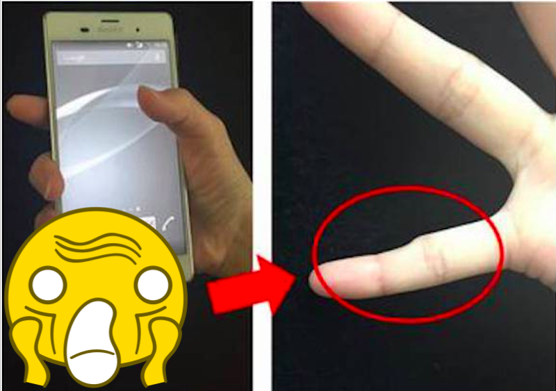 ระวัง! ถือมือถือผิดท่าวันละหลายชั่วโมง นิ้วก้อยอาจงอผิดรูปแบบนี้!